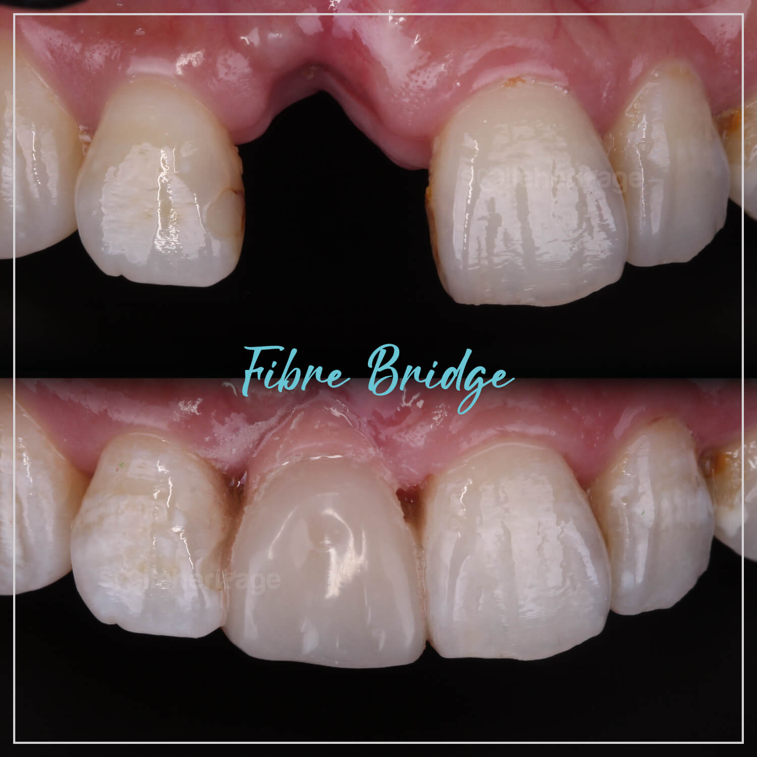 Fibre Bridge – SMILE HERITAGE DENTAL CLINIC